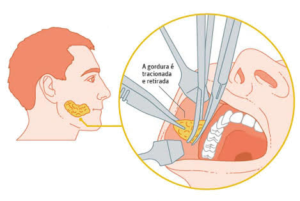 Bichectomia - Cirurgia nas Bochechas - Siga Odontologia