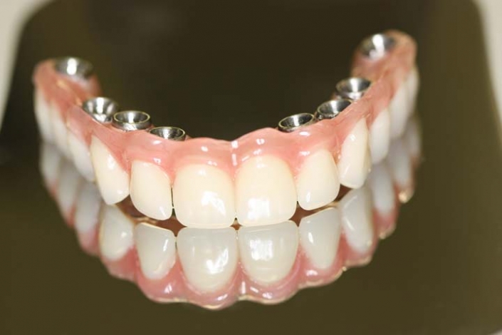 Como é realizado o protocolo dentário? - Implantes dentários e ...