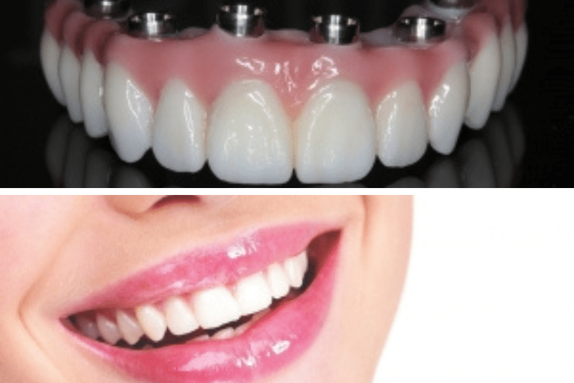 Protocolo dental – Tudo o que você precisa saber? - Implantes dentários ...
